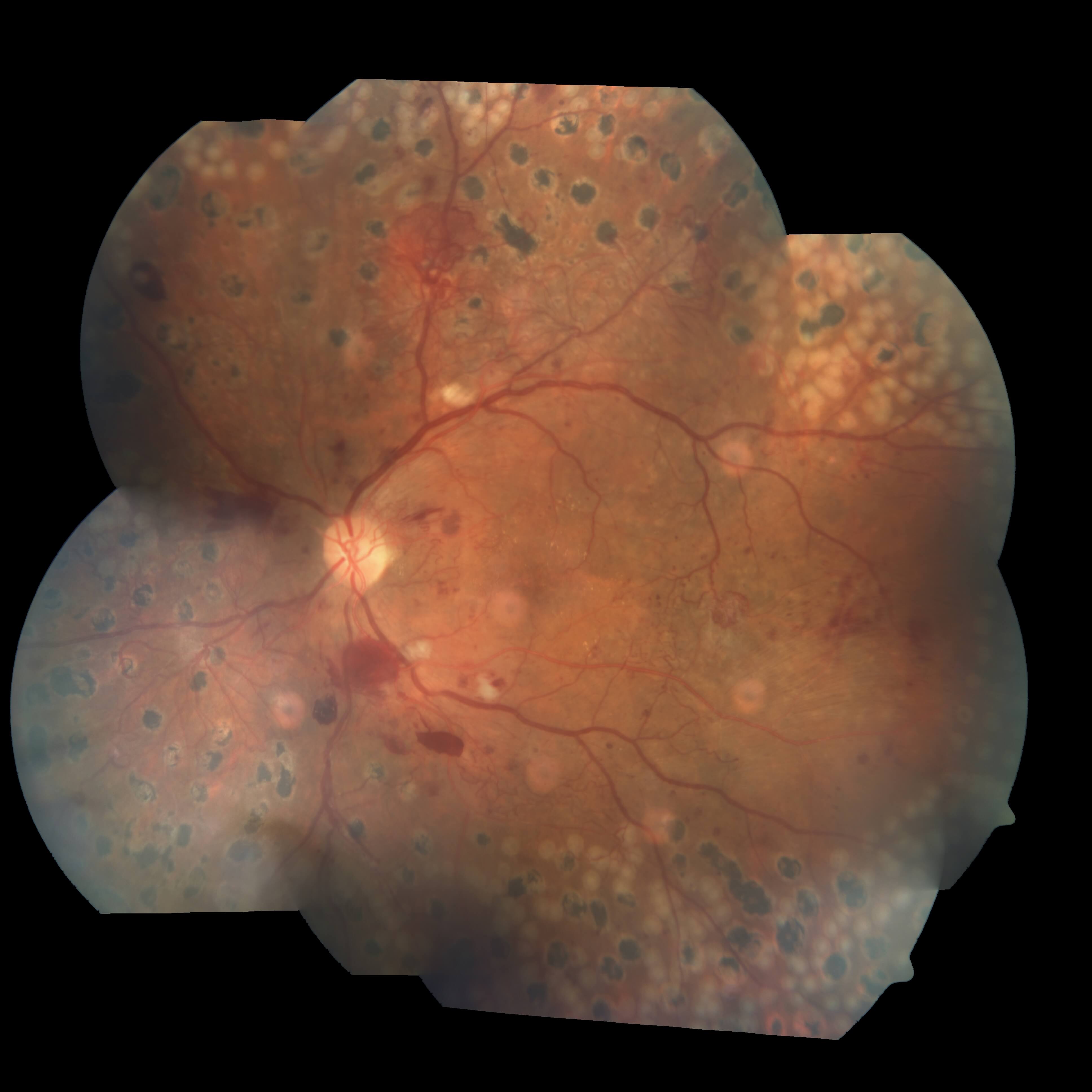 Gallery | Sri Isha Retina Foundation