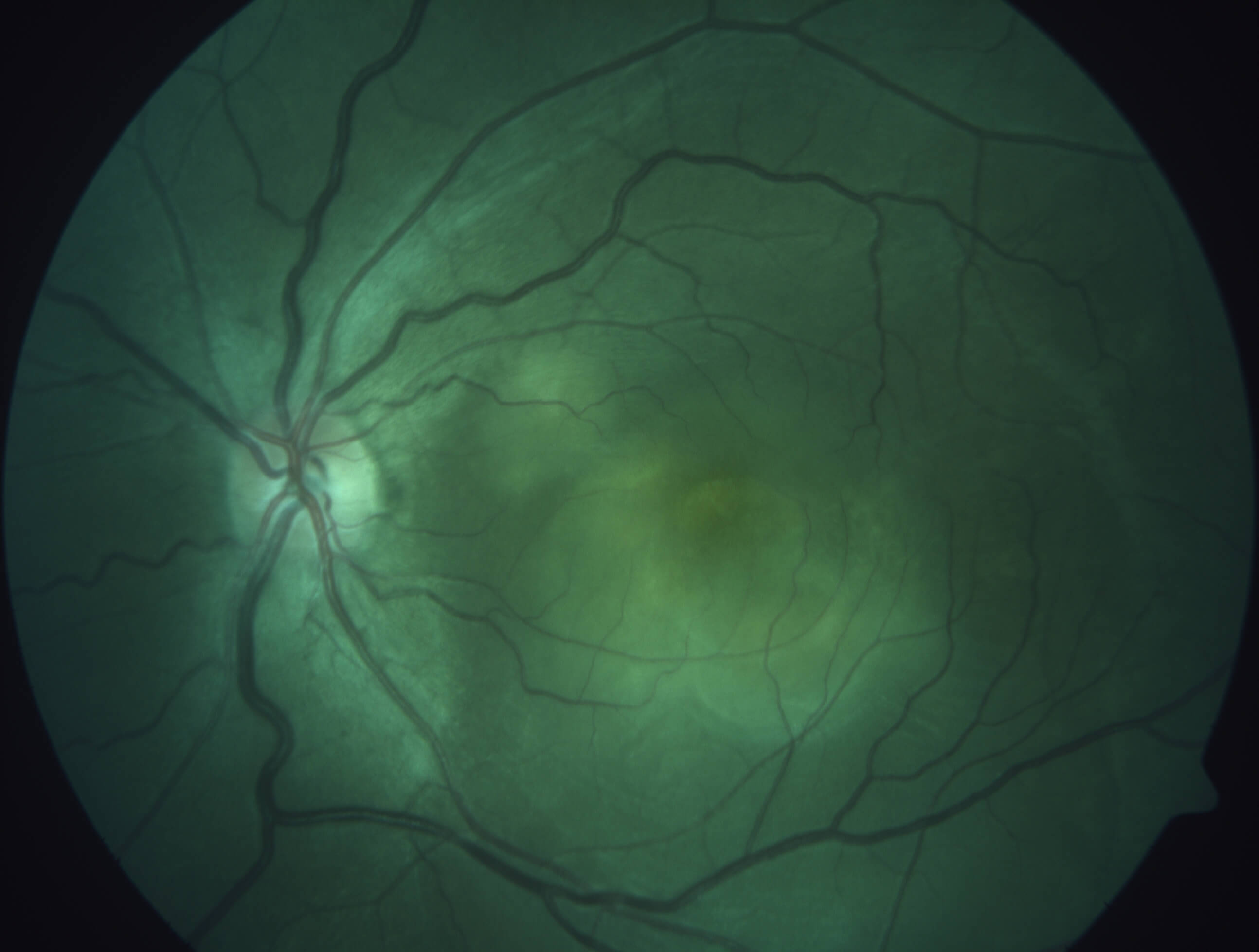 Gallery | Sri Isha Retina Foundation